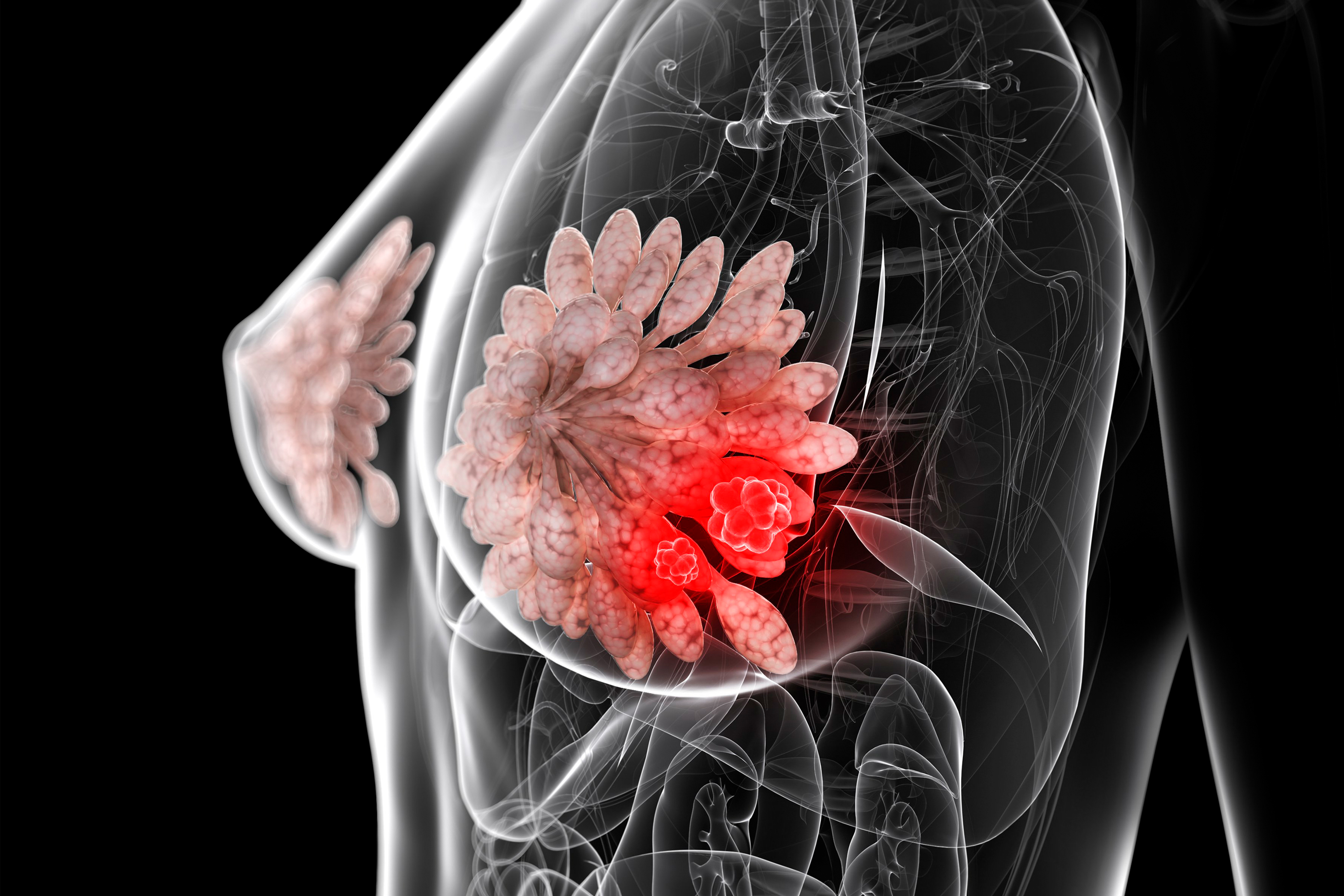 Expert Insights on ESR1-Mutated Metastatic Breast Cancer