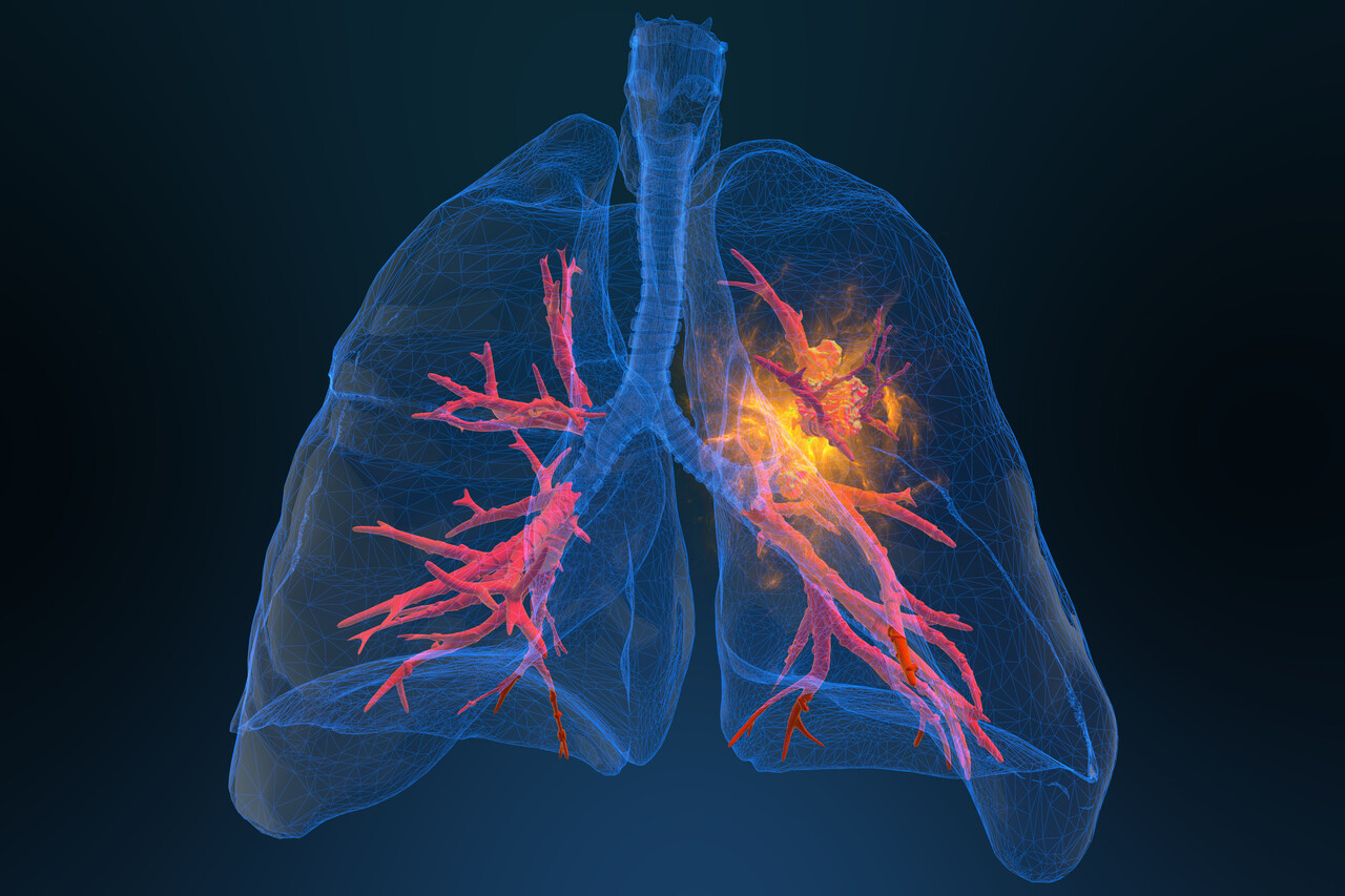 Adjuvant Osimertinib Boosts Survival in EGFR-Mutated Non-Small Cell ...