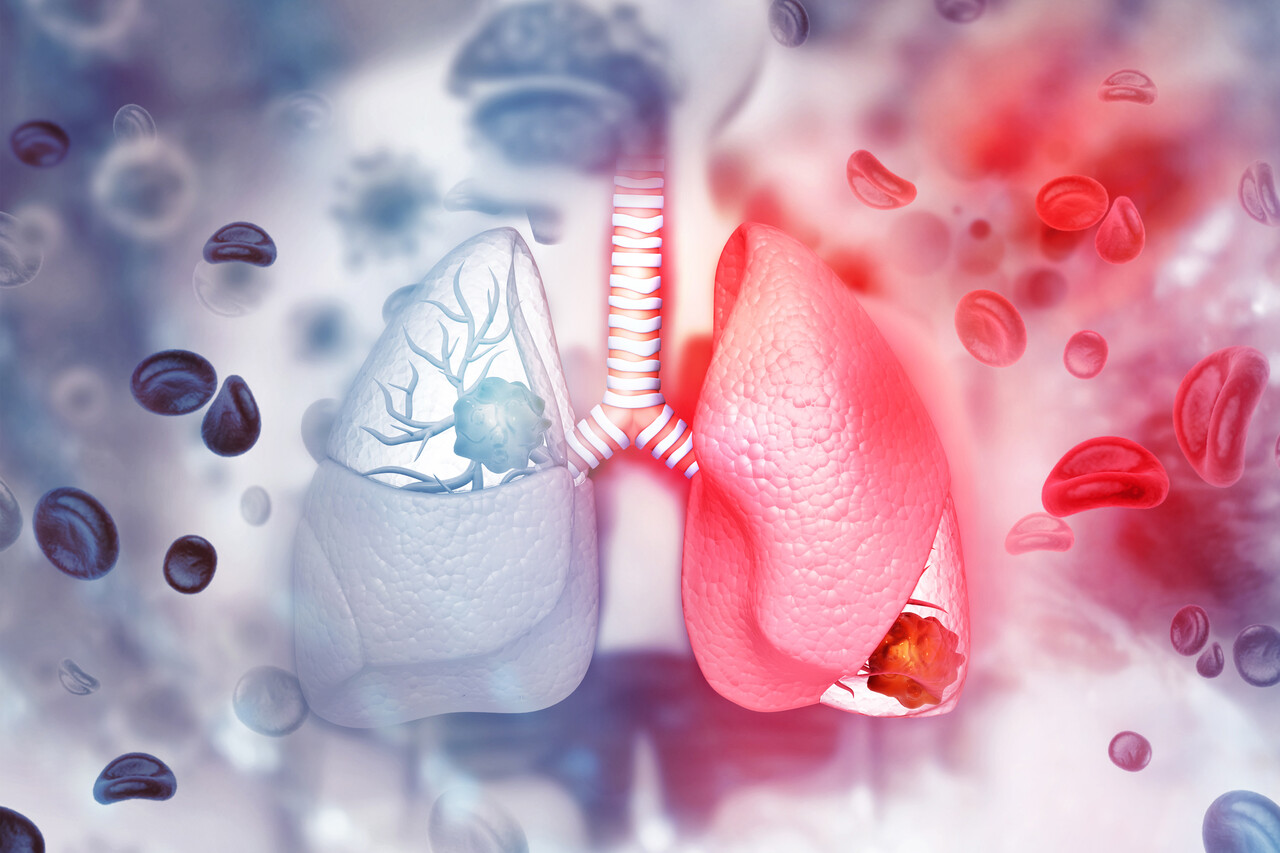 FDA Approves Tumor Treating Fields Device (Optune Lua) for Metastatic NSCLC
