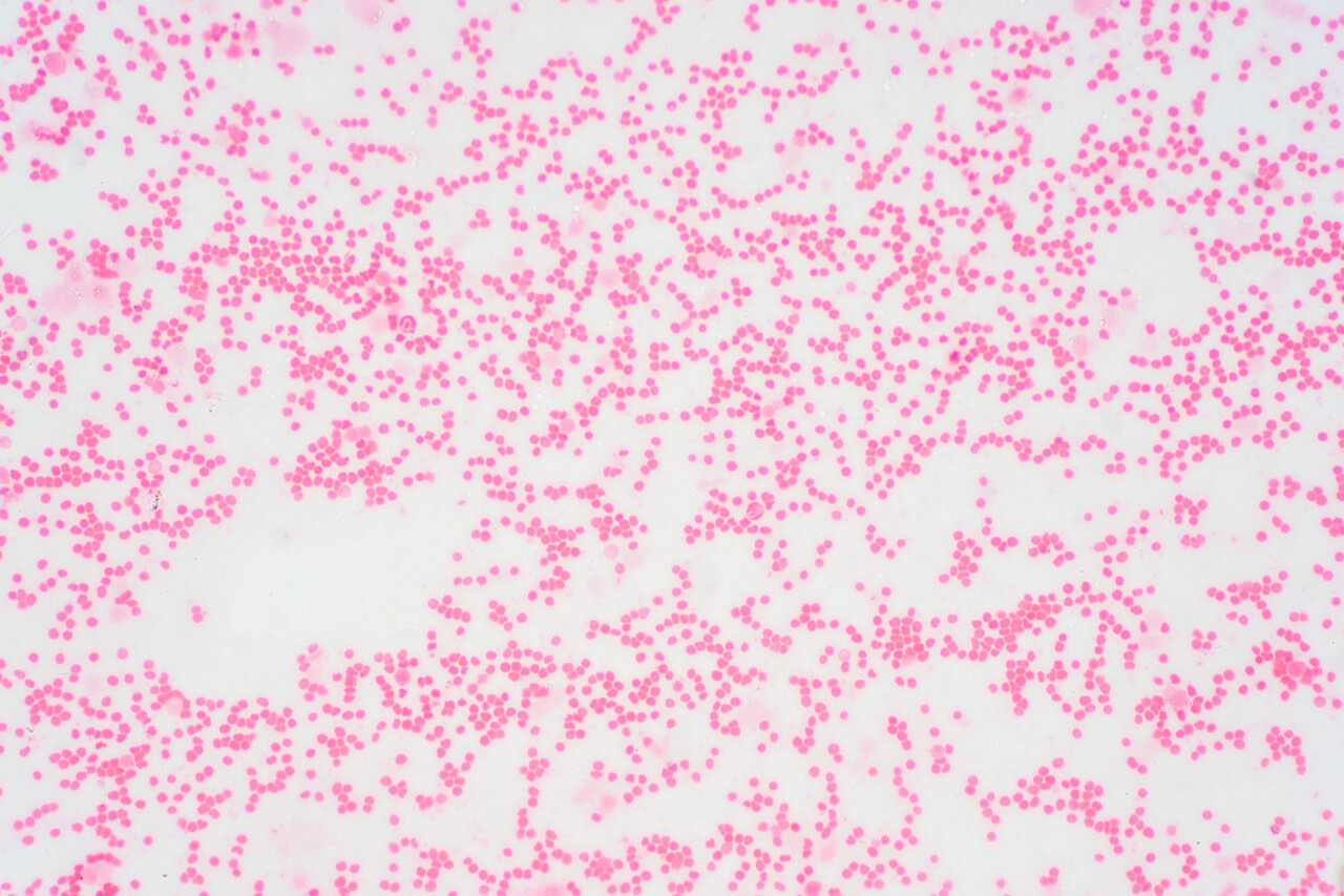 FDA Approves Imetelstat for Patients With Myelodysplastic Syndromes