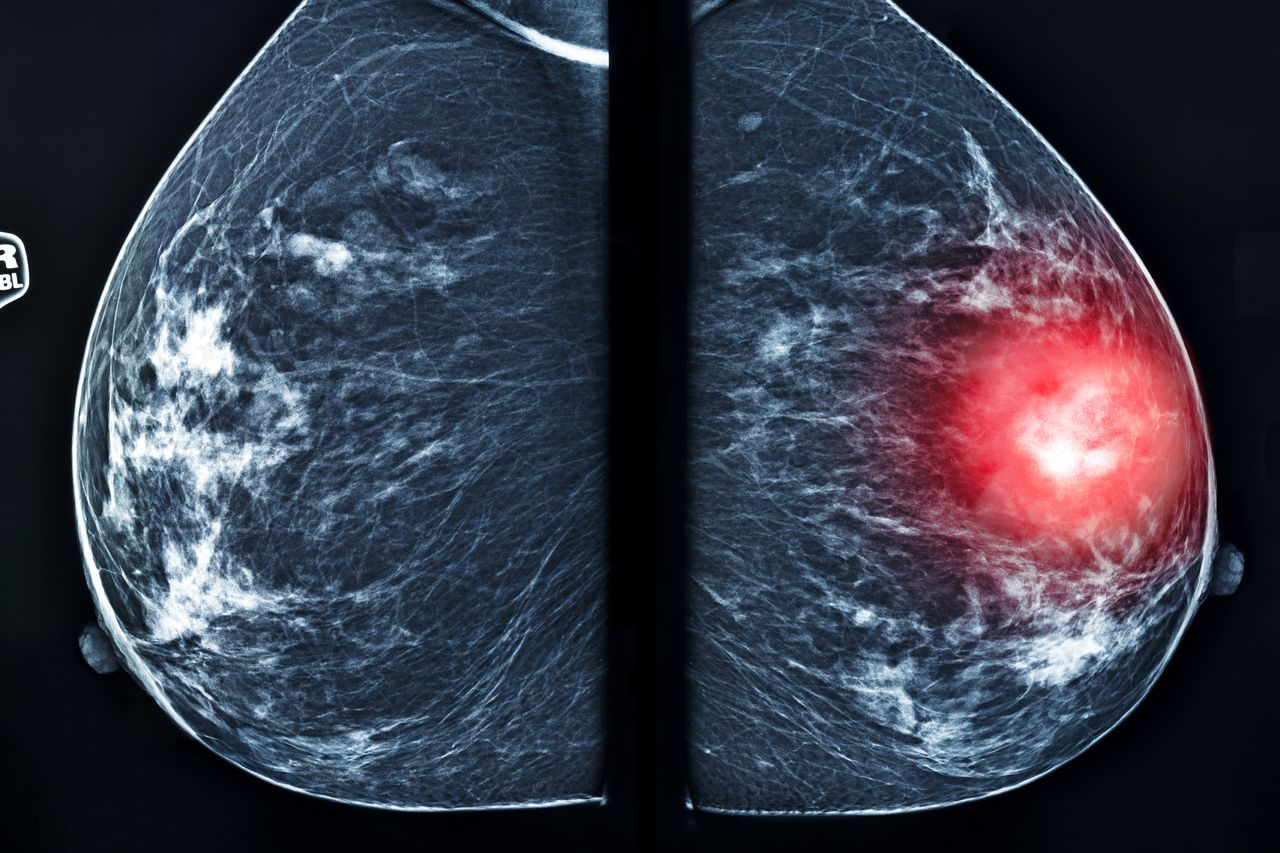 SERENA-6 Trial: Camizestrant Shows PFS Benefit in Advanced Breast Cancer
