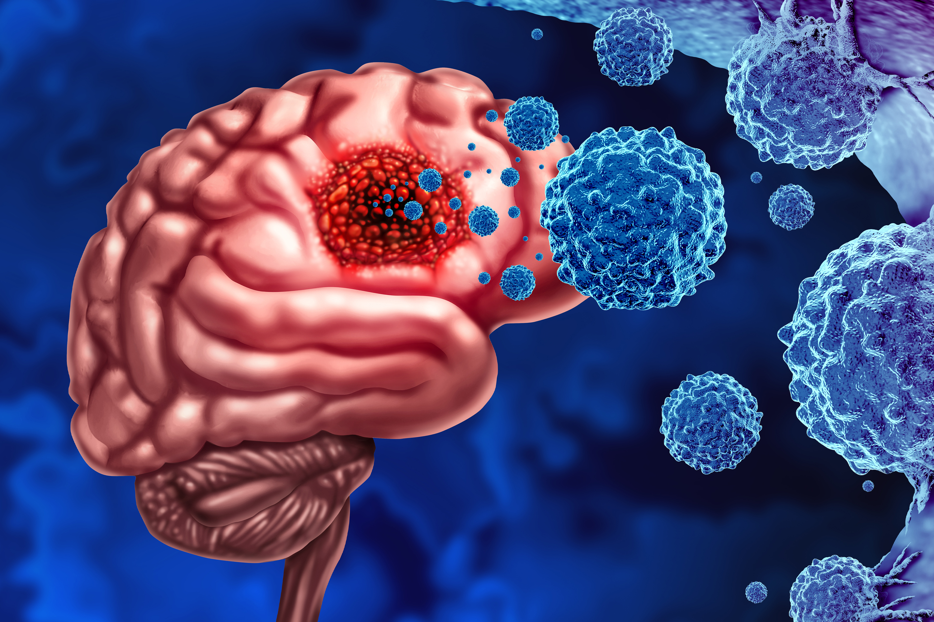 FDA Rejects Brain Cancer Drug