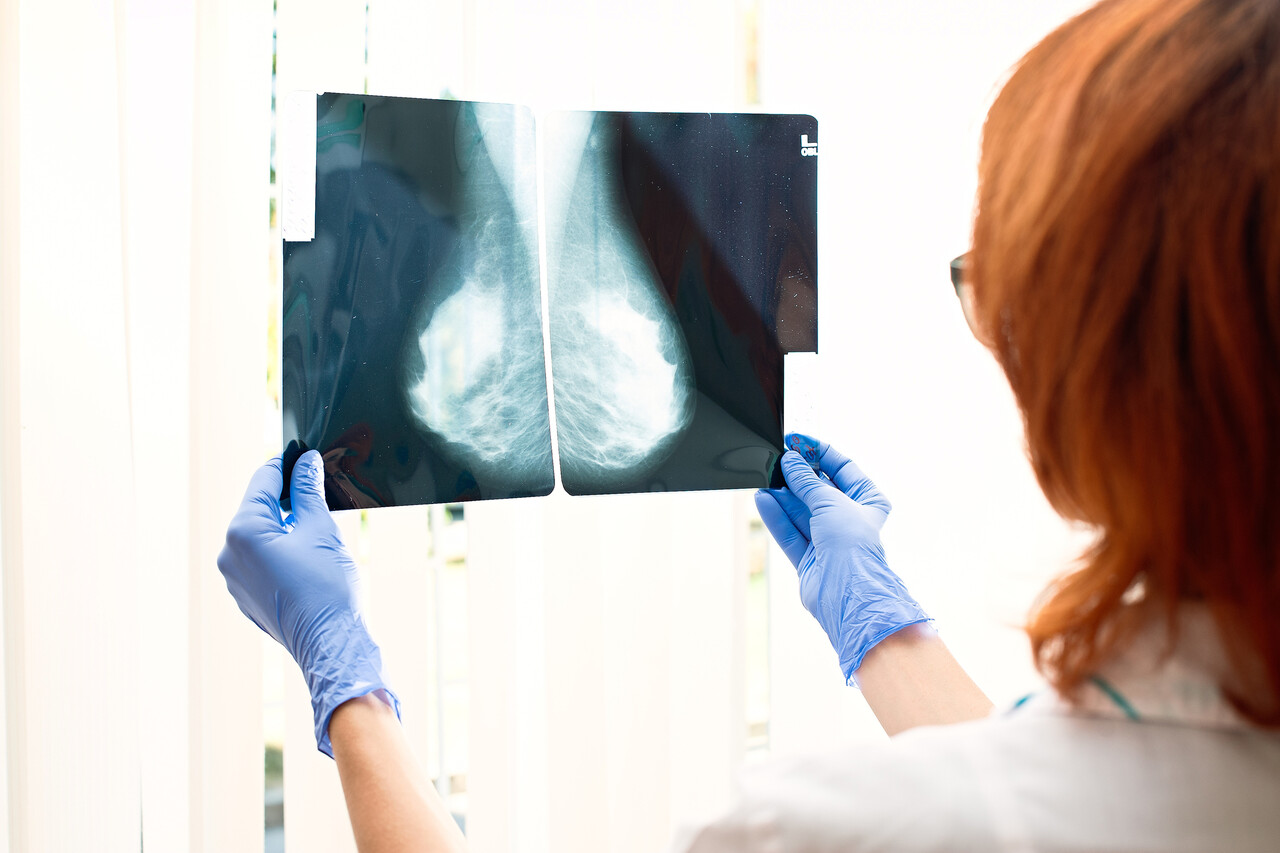 Triplet Therapy Emerges as “Promising New Option” for PIK3CA-Mutated ...