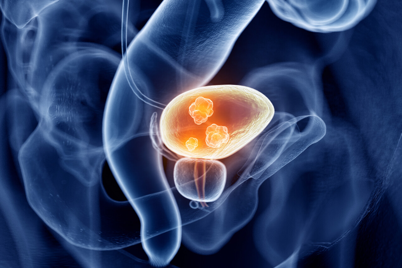 2024’s Biggest News in Bladder Cancer Care