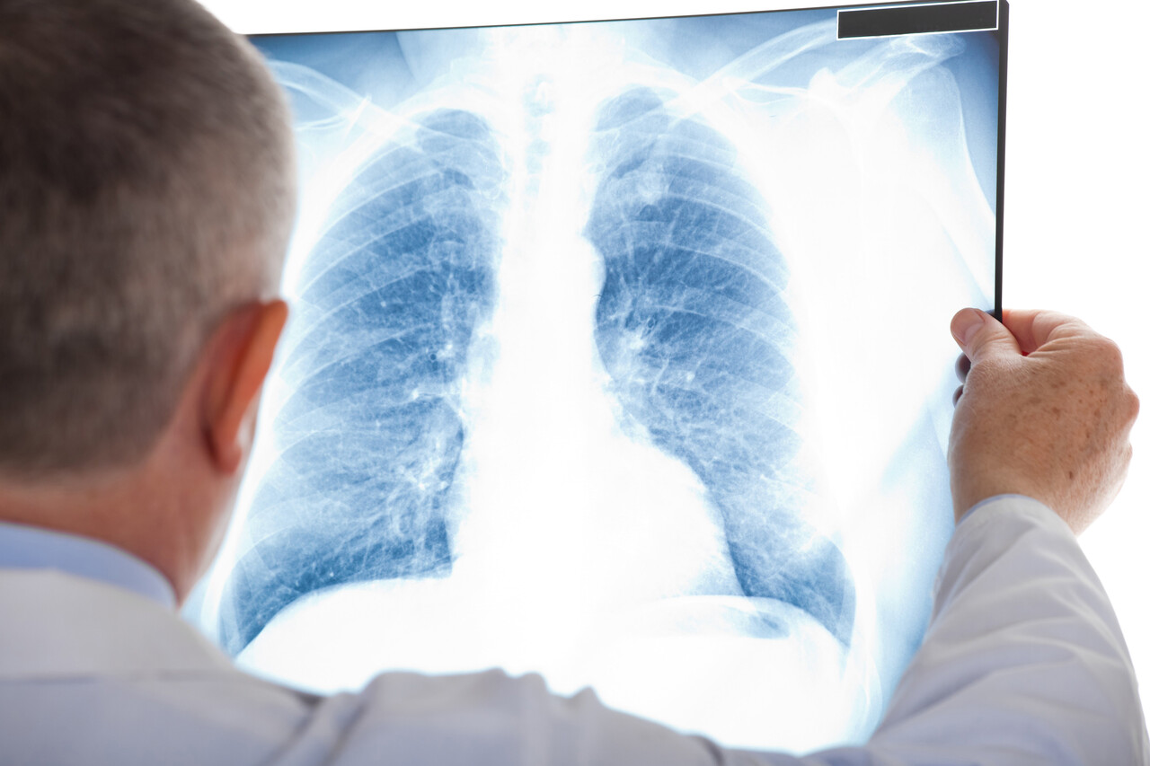 FDA Approves Monthly Dosing for Subcutaneous Amivantamab in EGFR ...