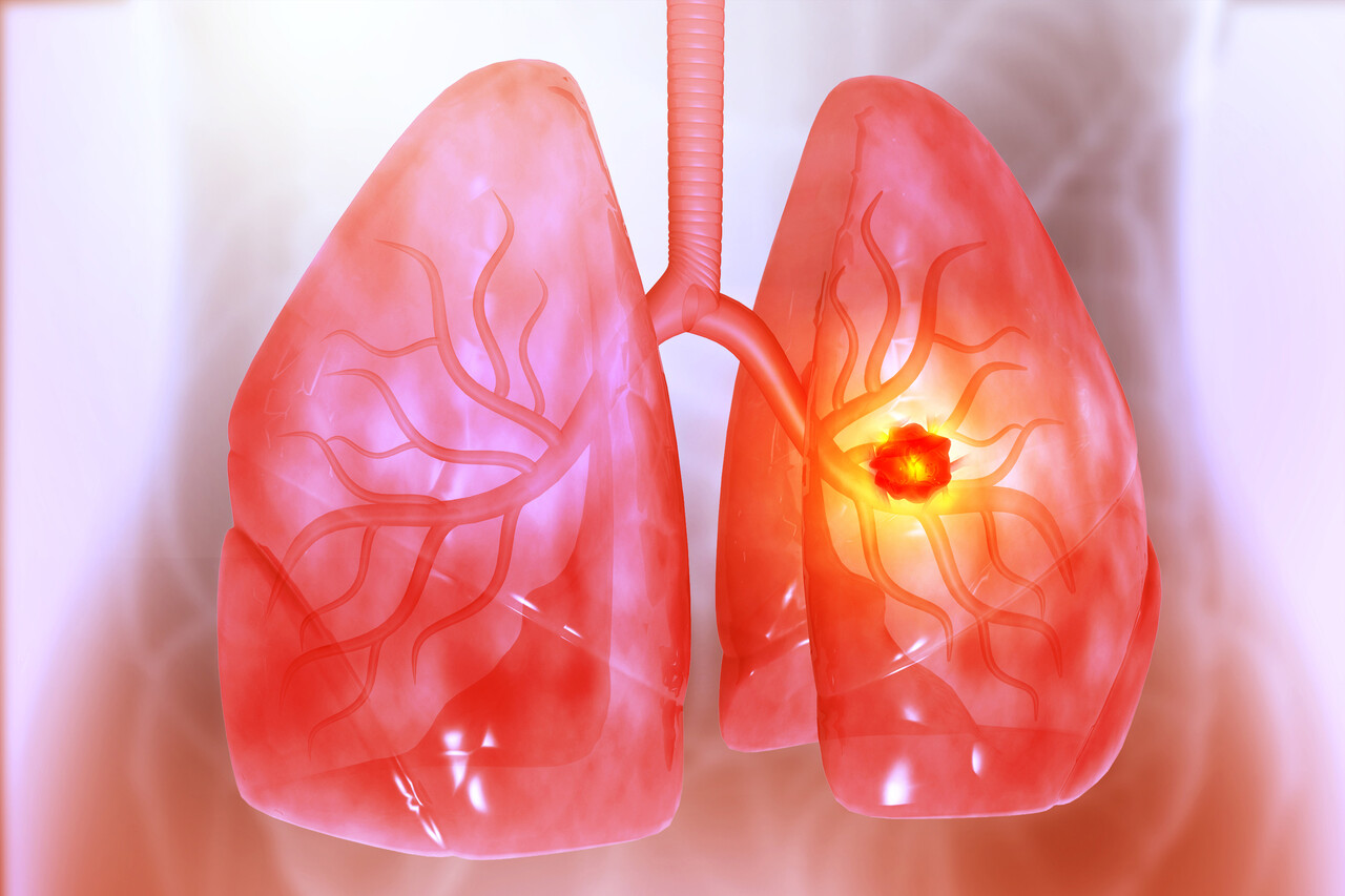 Immunotherapy Combo Fails to Improve Survival in Limited-Stage Small ...