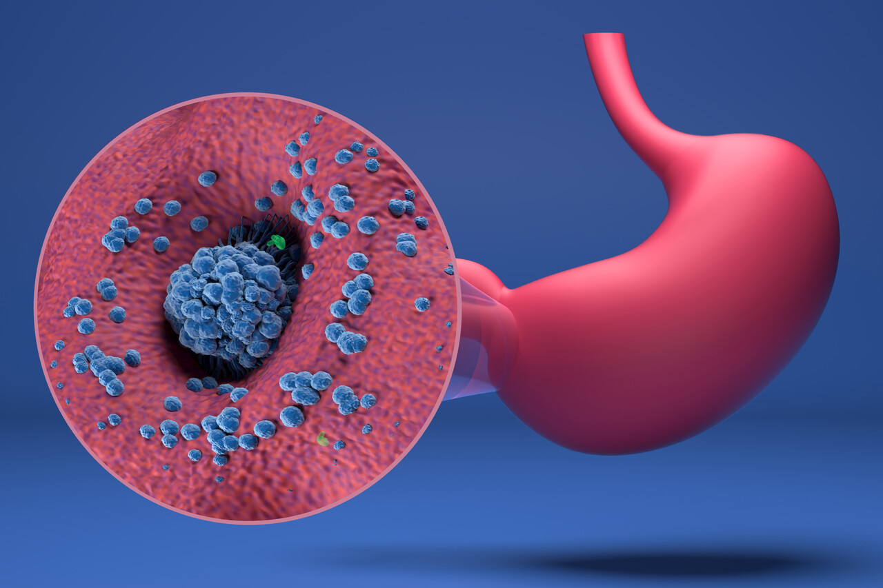 FORTITUDE-101 Data at ESMO 2025: Bemarituzumab’s Survival Benefit in ...