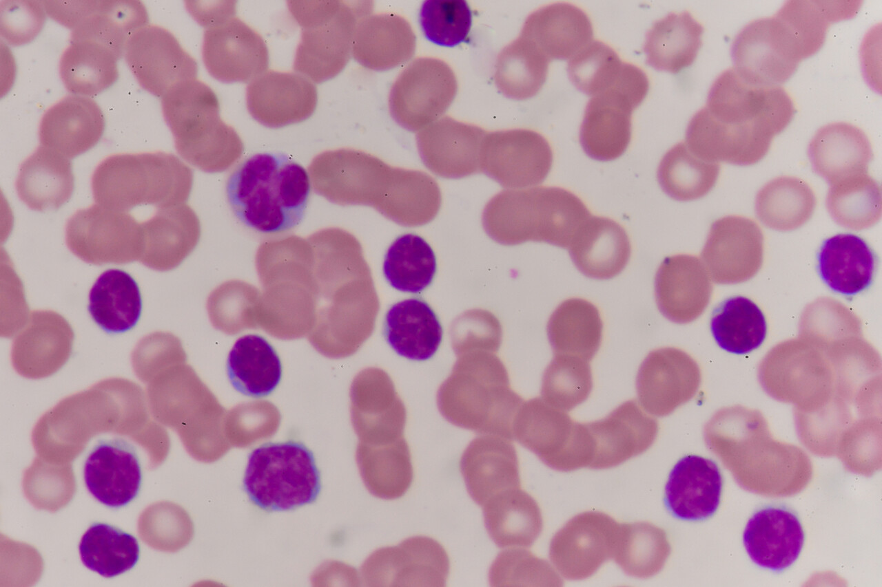 Bispecific Antibody Epcoritamab (Epkinly) Yields High Response Rates in ...