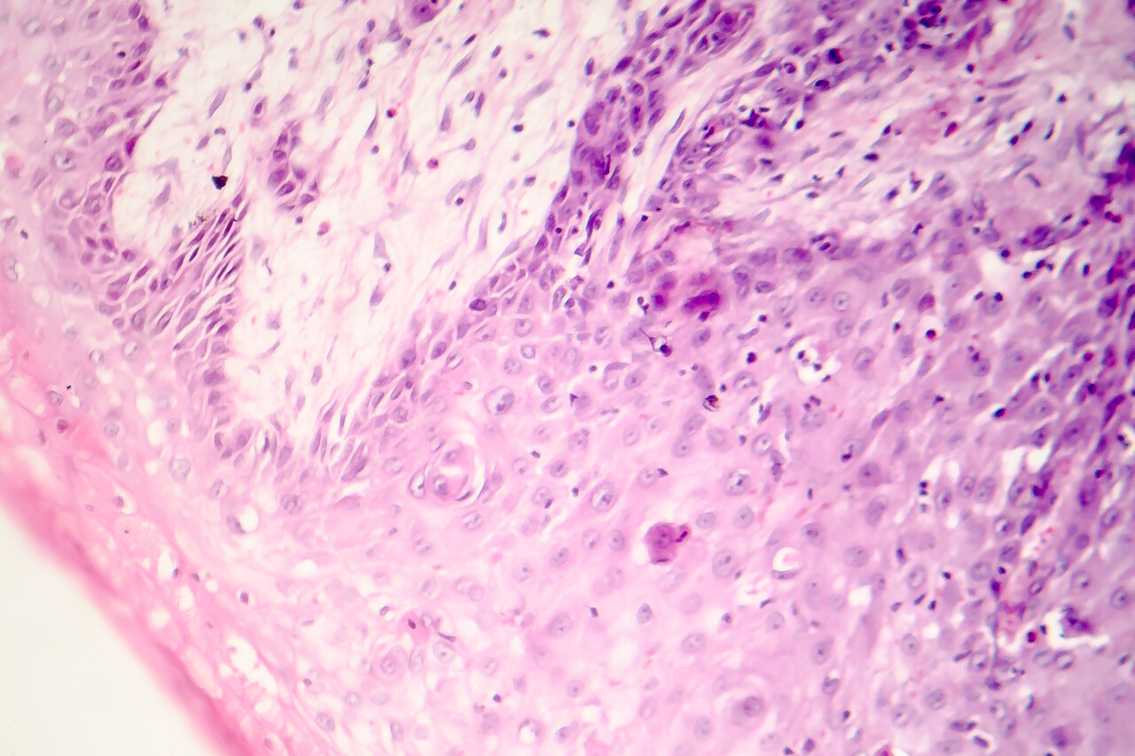 FDA Approves Cosibelimab-Ipdl (Unloxcyt) for Advanced Cutaneous ...