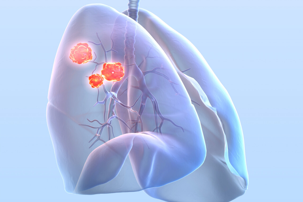 FDA Approves Lurbinectedin (Zepzelca) Combination for Extensive-Stage ...