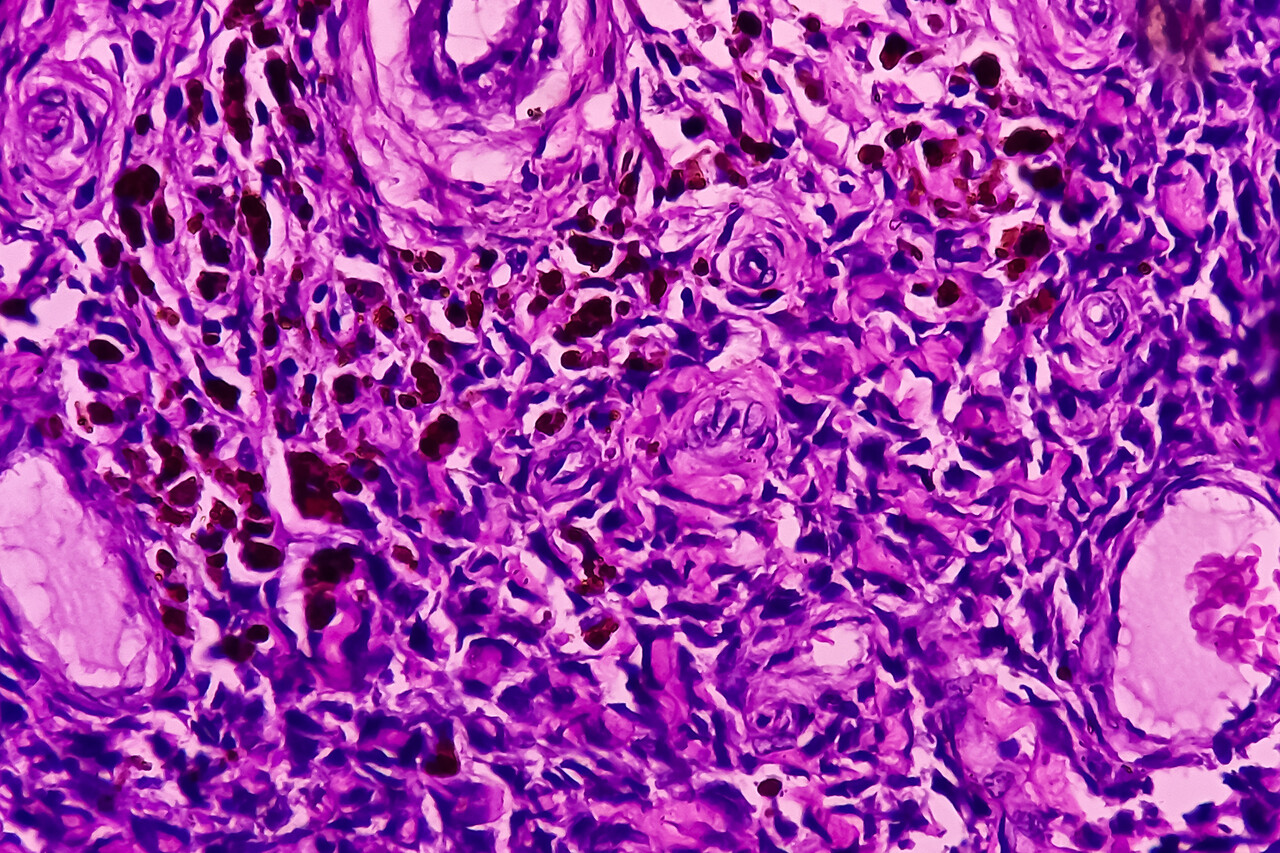 FDA Approves Afamitresgene Autoleucel (Tecelra) as First Engineered ...