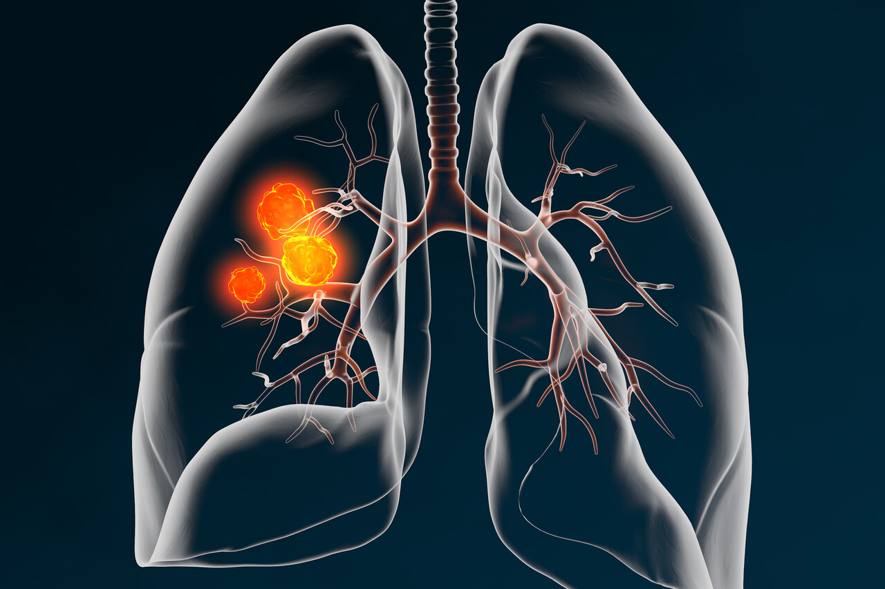 “Unprecedented” Benefit: Lorlatinib Tied to Longest PFS Ever Reported ...