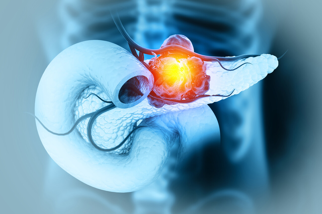 FDA Approves Irinotecan Liposome Combo in Metastatic Pancreatic Cancer