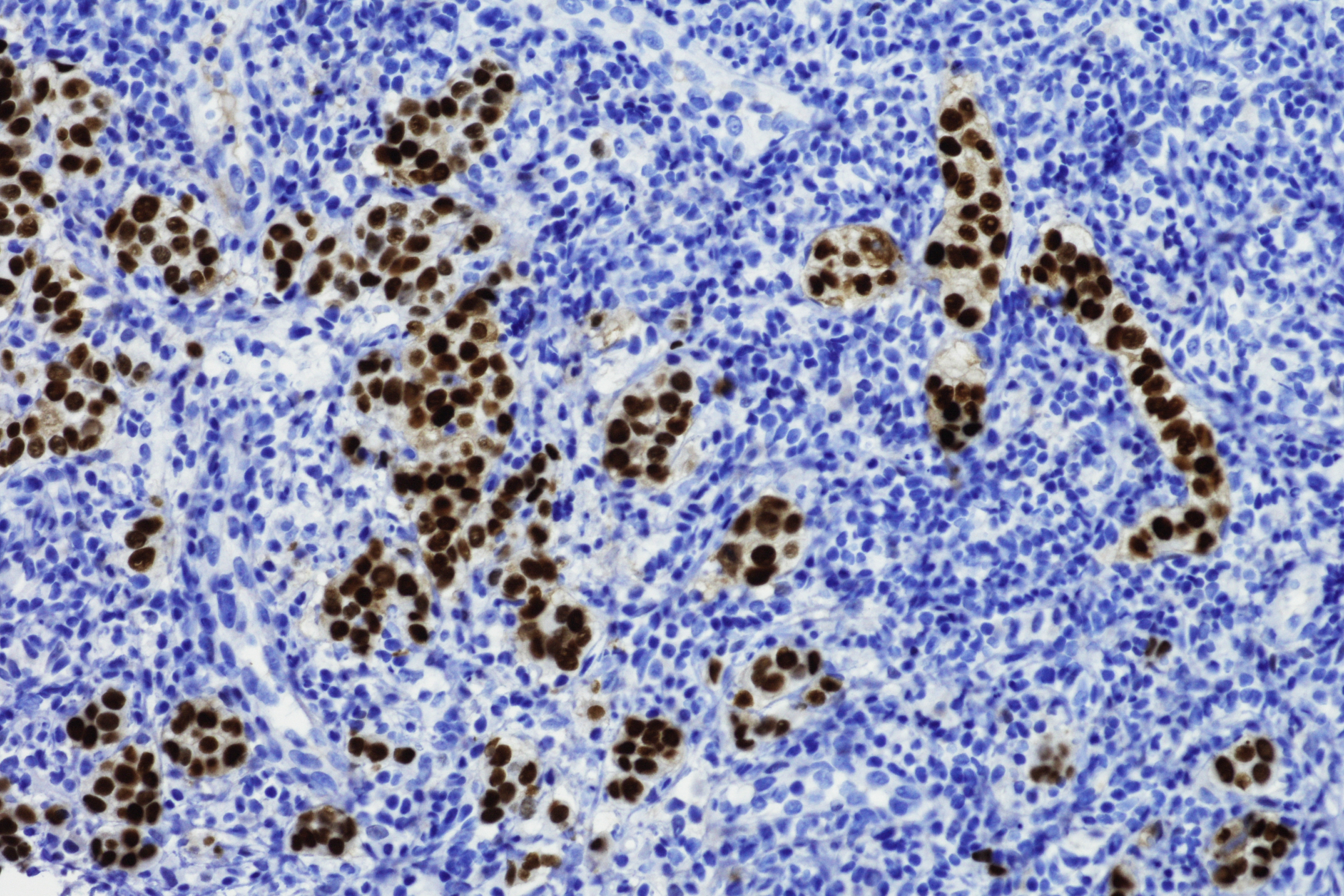 Tucatinib, ADC Combo Boosts PFS in Advanced HER2-Positive Breast Cancer