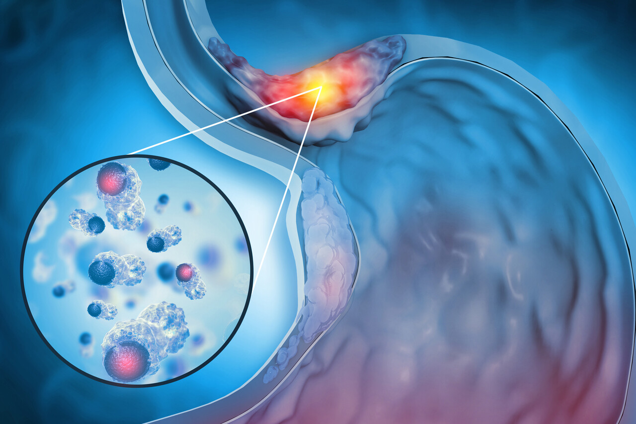 Progress in HER2-Negative Advanced Gastric Cancer