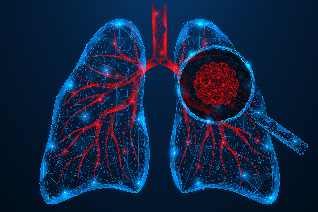 Neoadjuvant Osimertinib in EGFR-Mutated NSCLC: New Data, Same Questions?