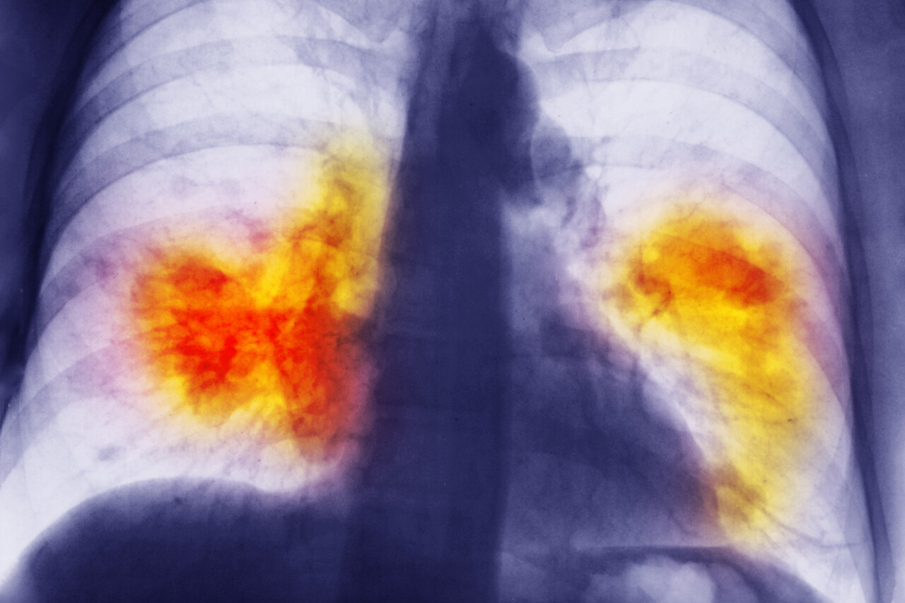 FDA Approves Adjuvant Alectinib for ALK-Positive NSCLC