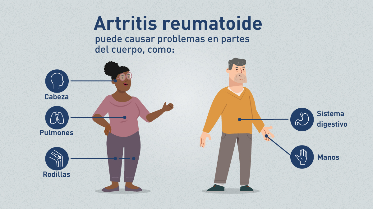 Artritis reumatoide: la enfermedad oculta | Lilly Trials Blog