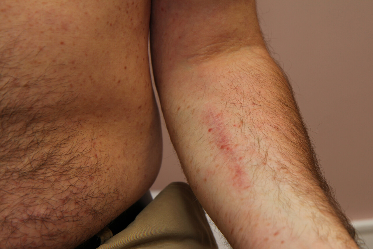 Leukemia Bruises Back Leukemia Symptoms You Shouldn't Ignore