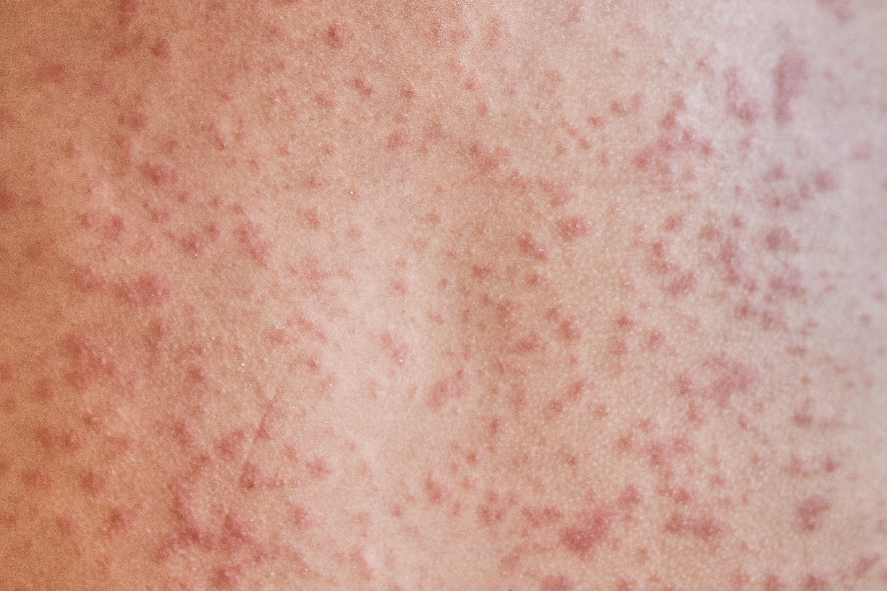 Hodgkin Lymphoma Rash: Understanding Skin Changes