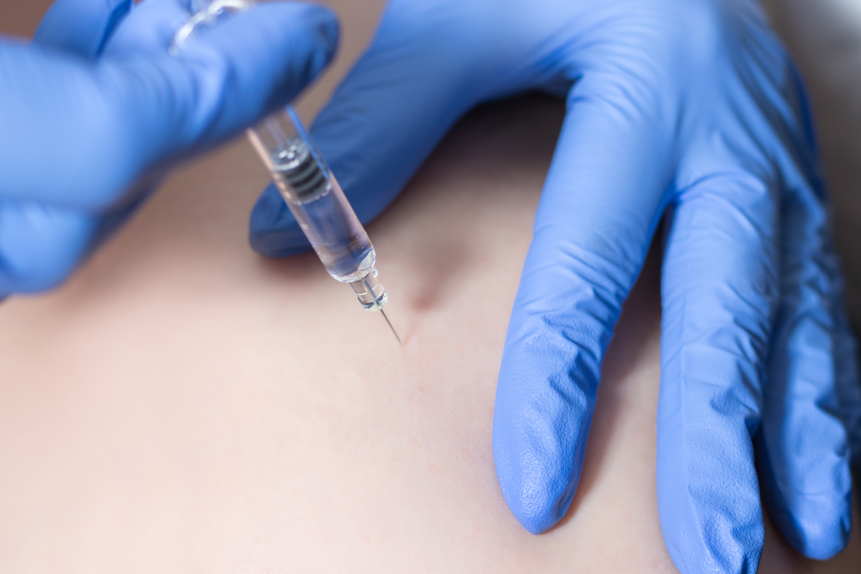 Subcutaneous Therapy: What to Expect Before, During, and After