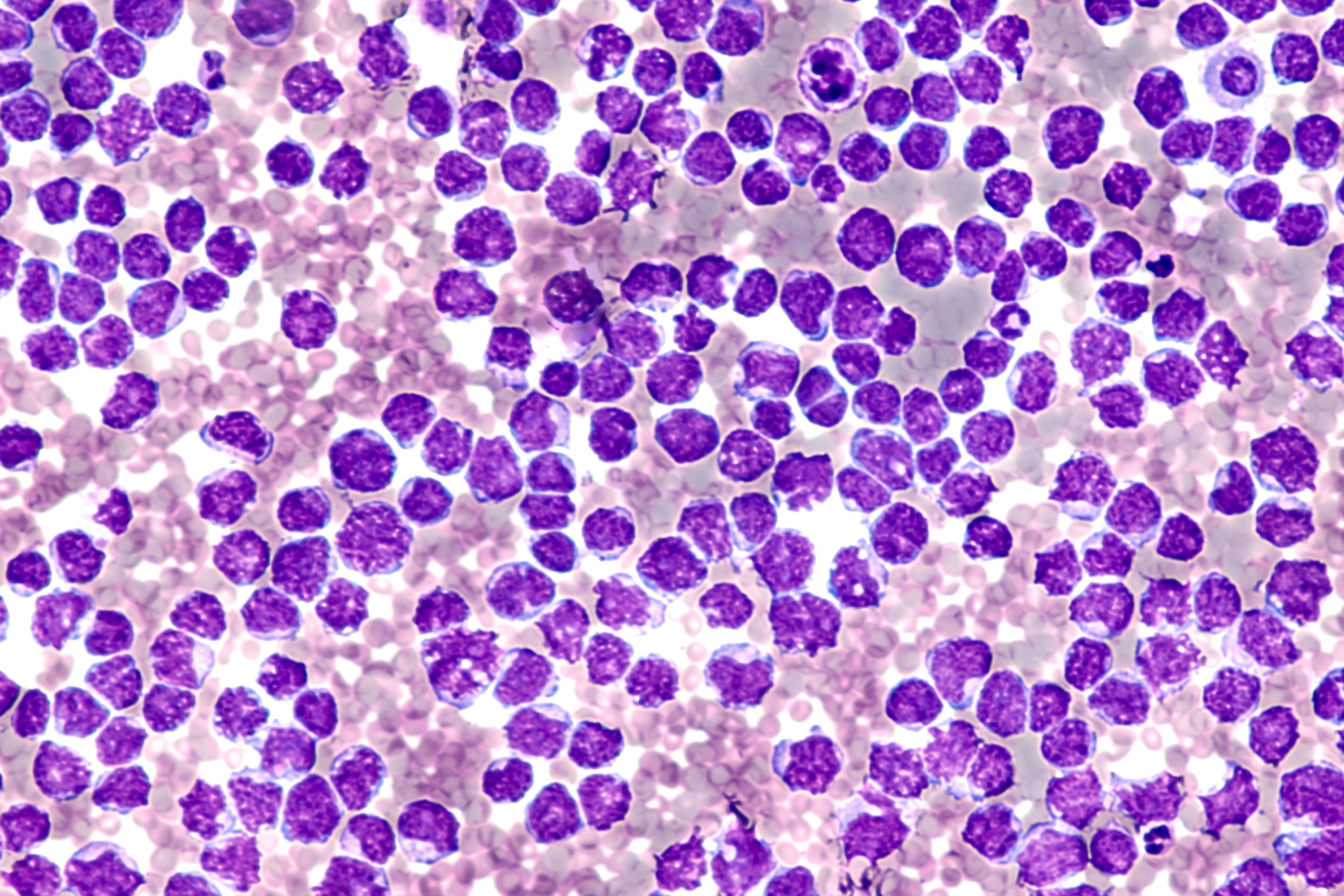 High-Risk MCL: What is it, and How is it Treated?