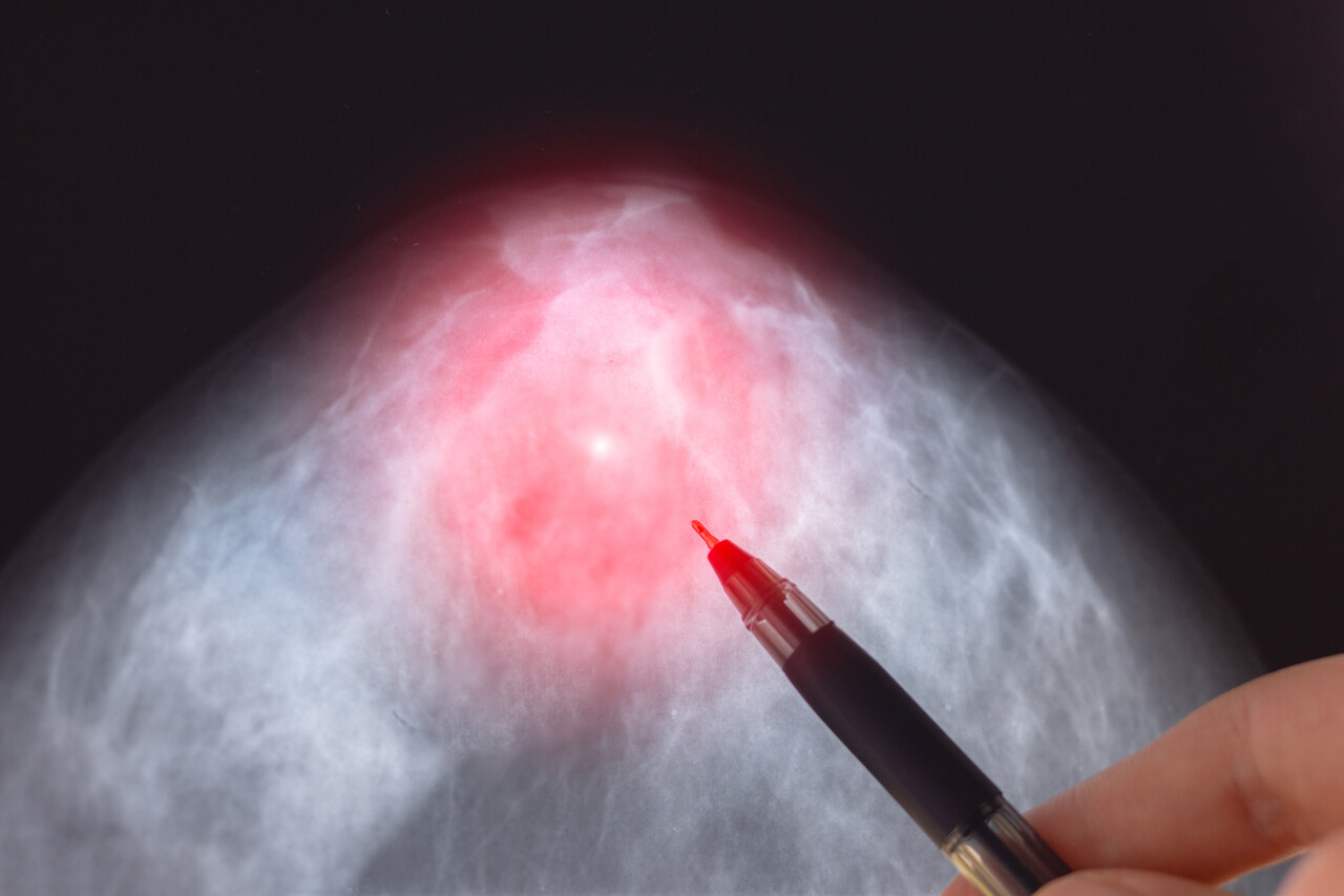 Breast Dimpling: Can This Be a Sign of Breast Cancer?