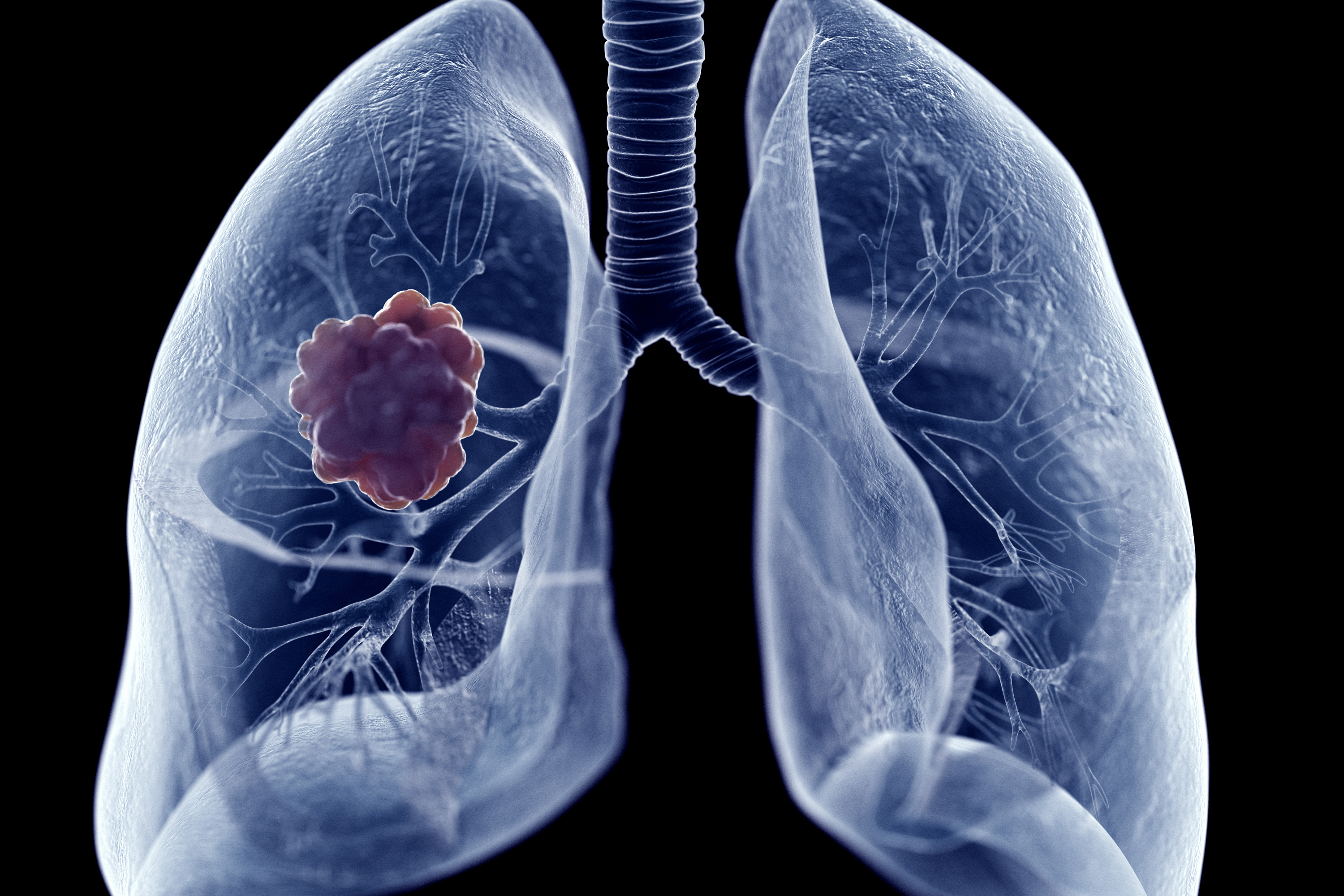 Carcinoid Tumor in the Lung: Symptoms, Diagnosis, and Treatment