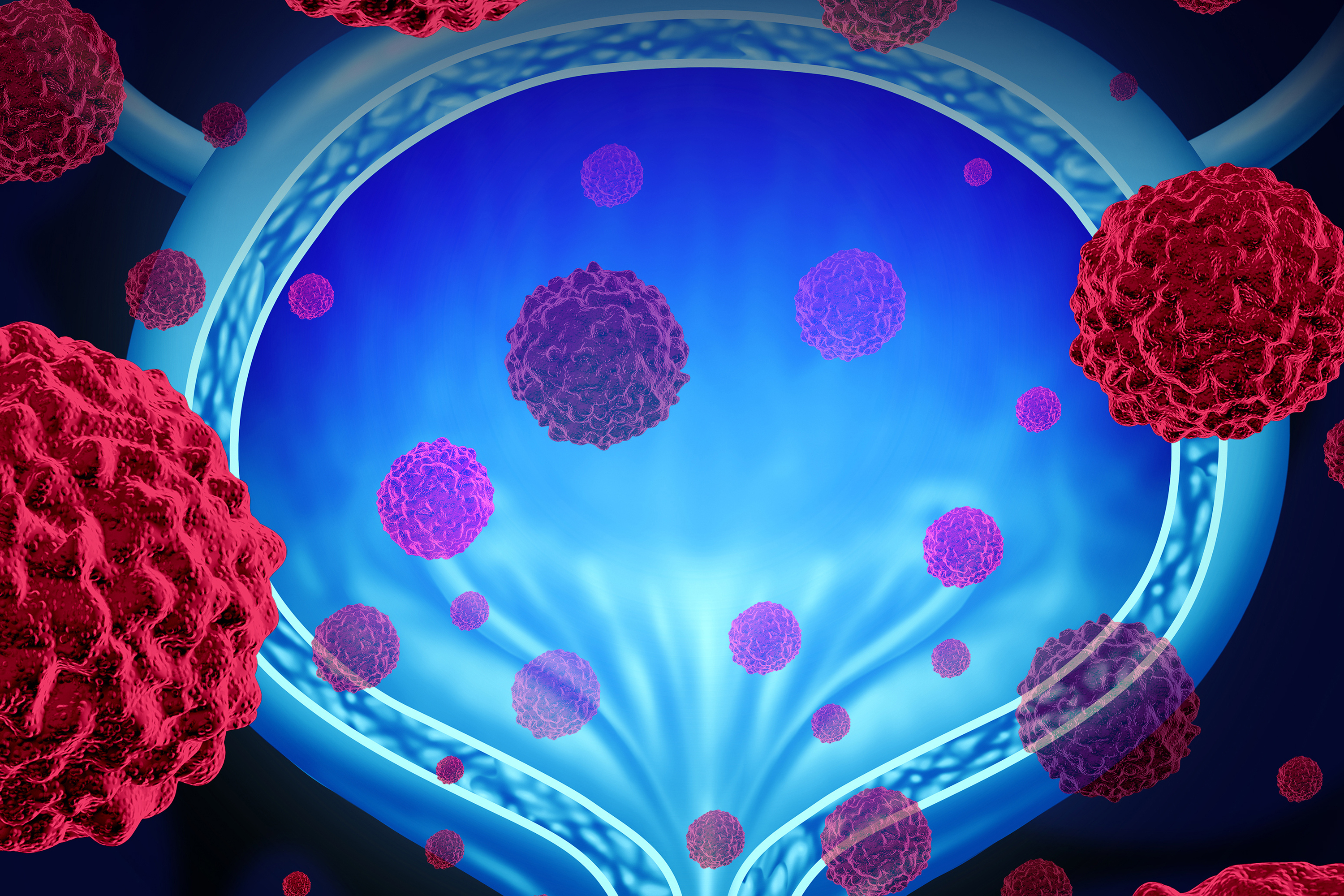 How Fast Does Bladder Cancer Spread?