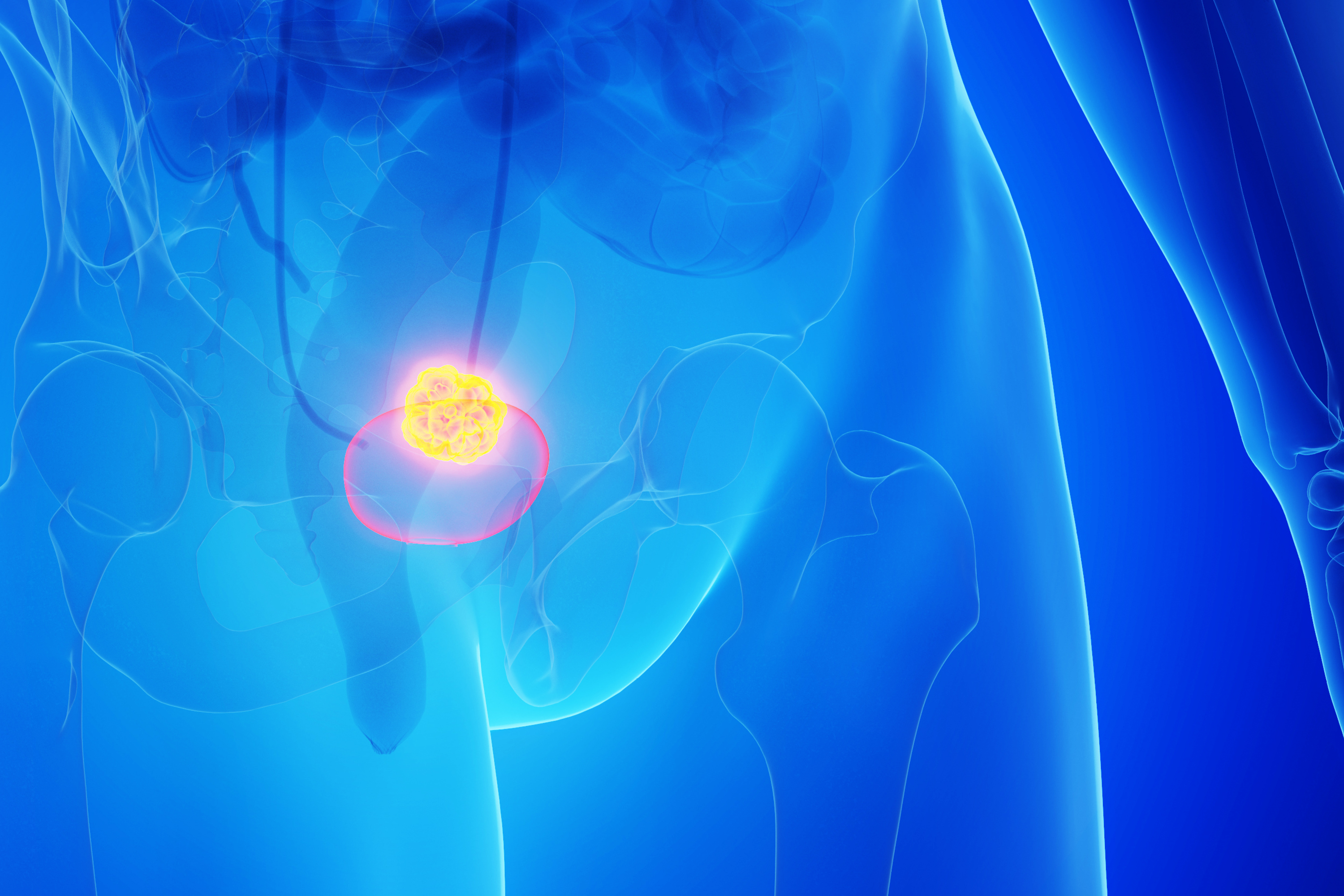 Bladder Fulguration: Everything You Need To Know