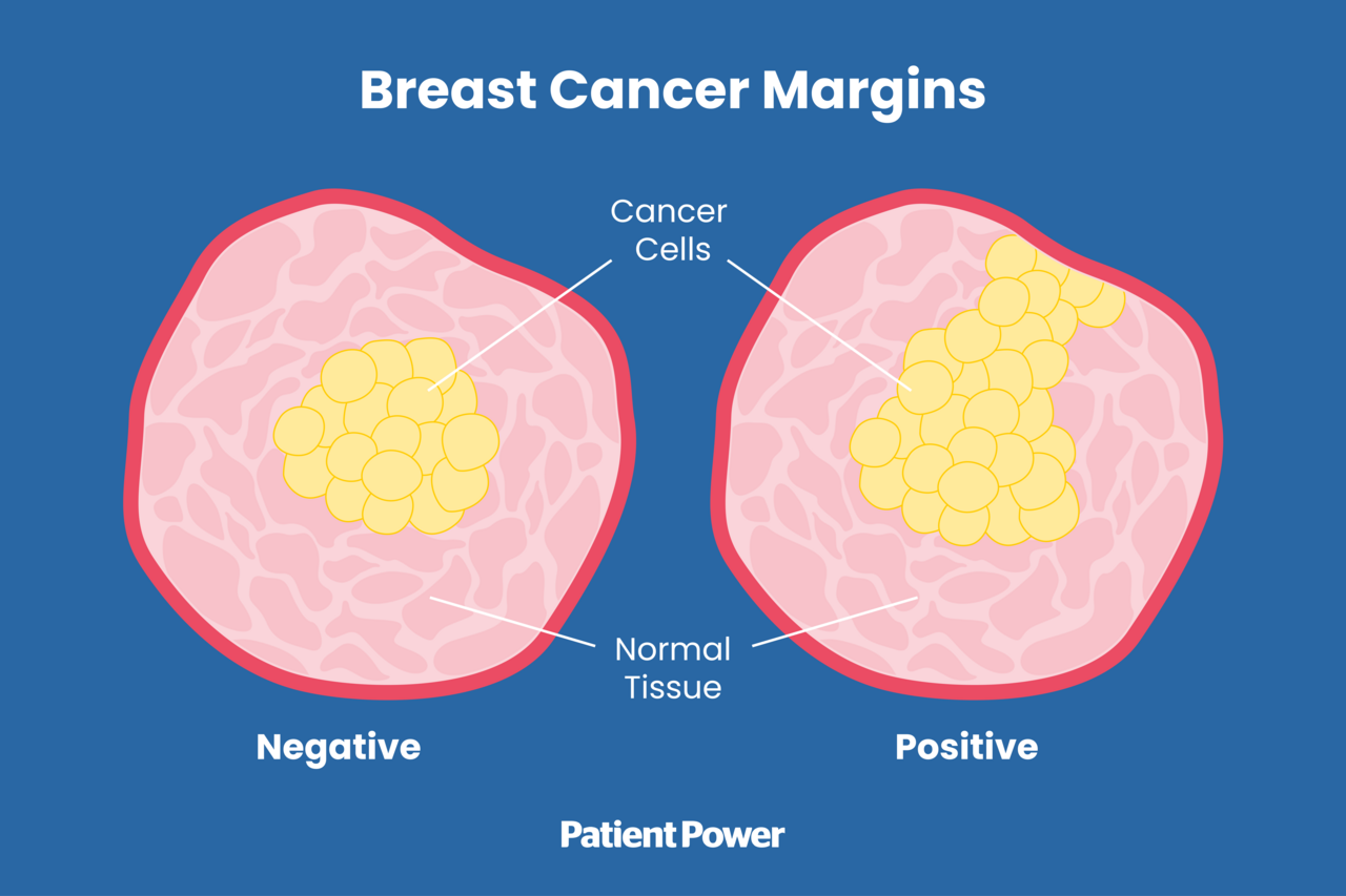 Breast Cancer Margins: What You Need to Know