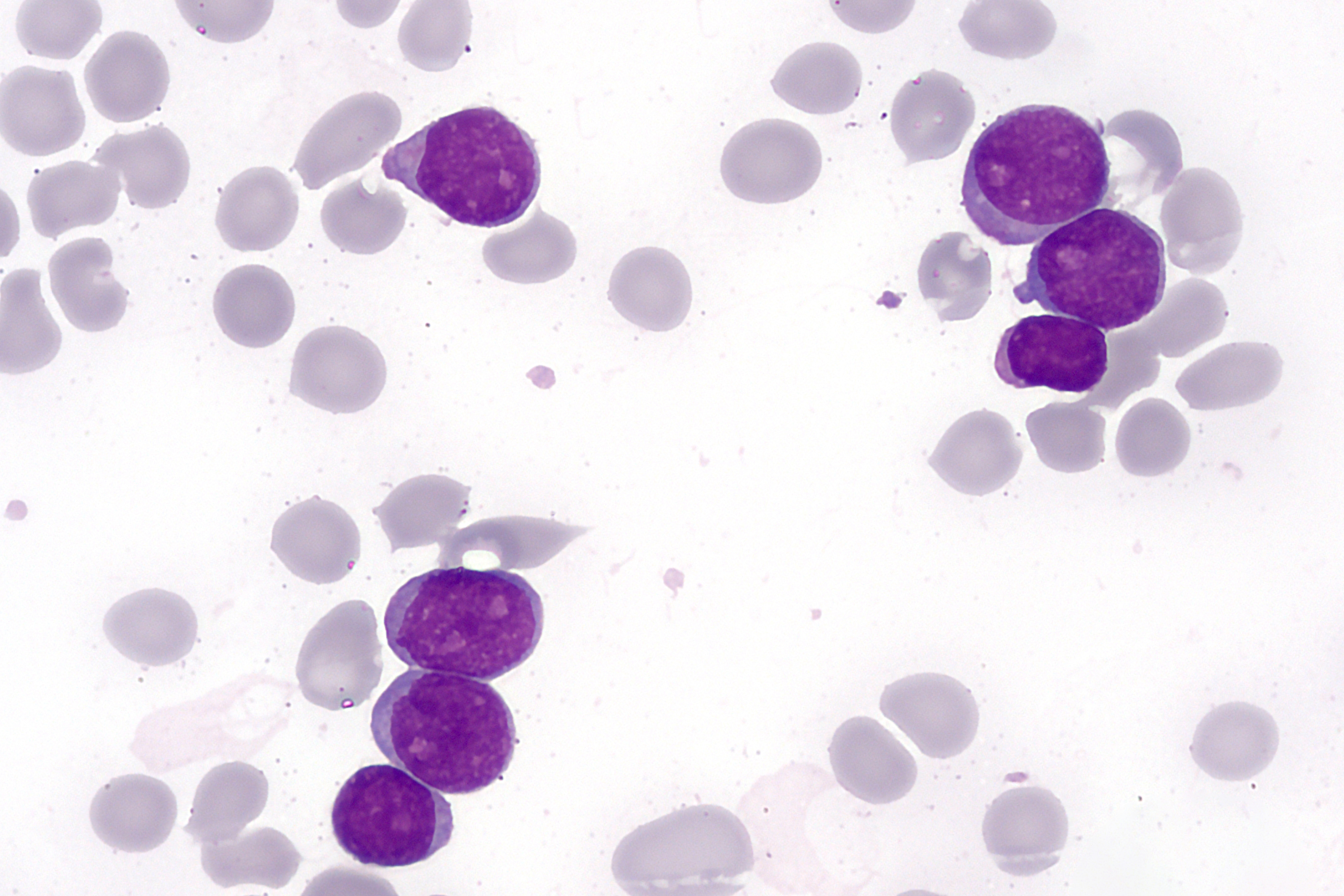 AML vs ALL: Differences in Symptoms, Treatments, & More