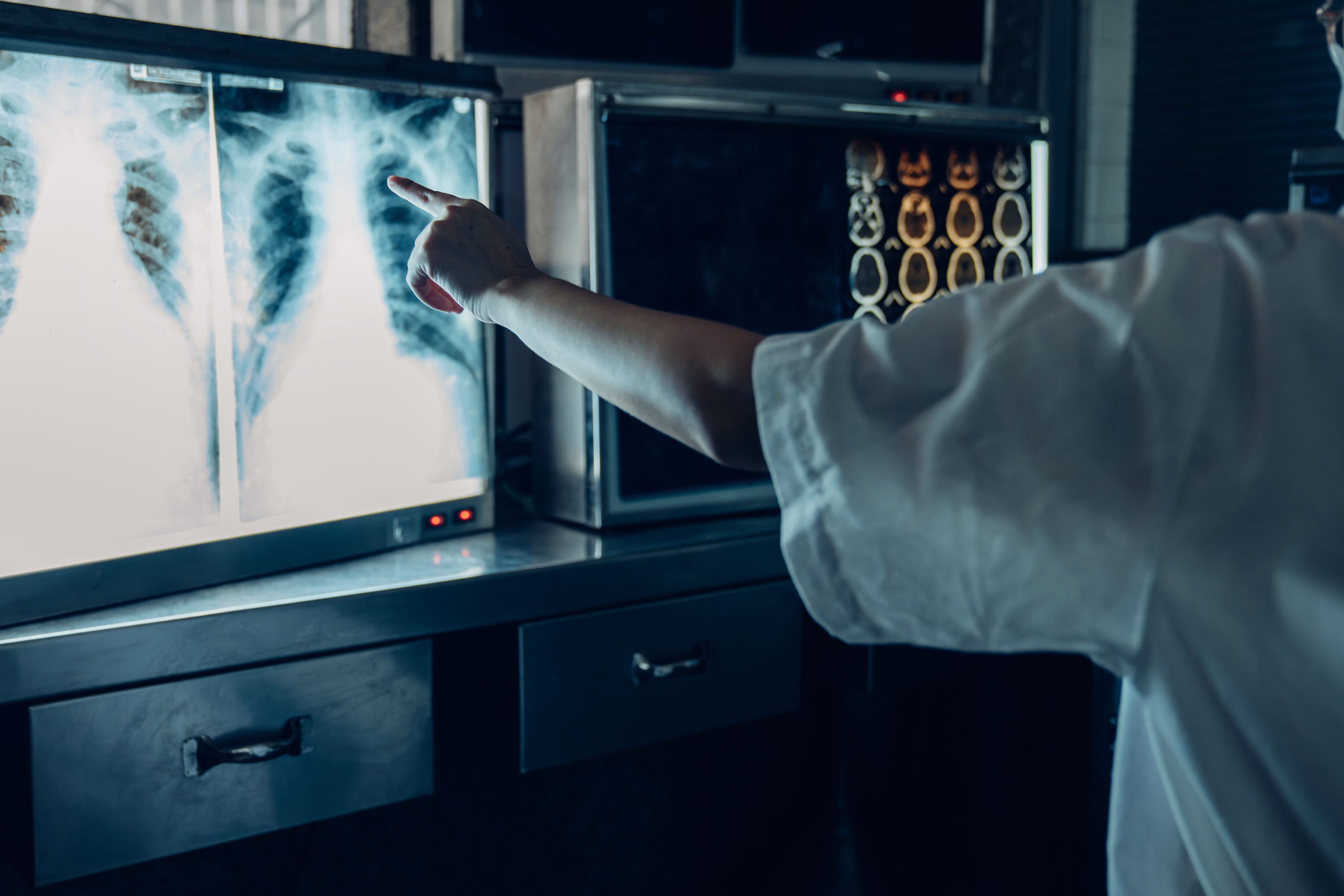 Inoperable Lung Cancer: Types, Treatment and Life Expectancy