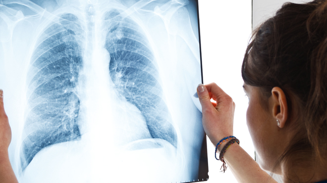 NSCLC: From Getting Accurately Diagnosed to Understanding Your ...