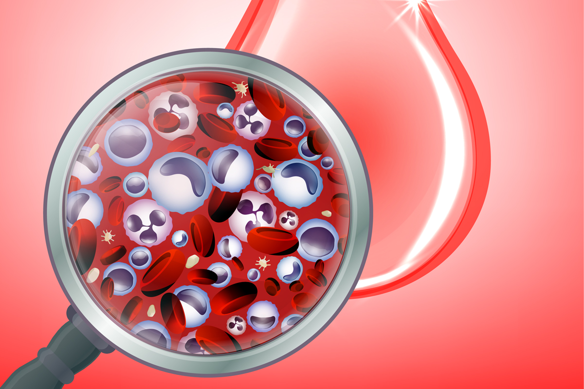 Chronic Lymphocytic Leukemia (CLL) Treatment Response: MRD Tests