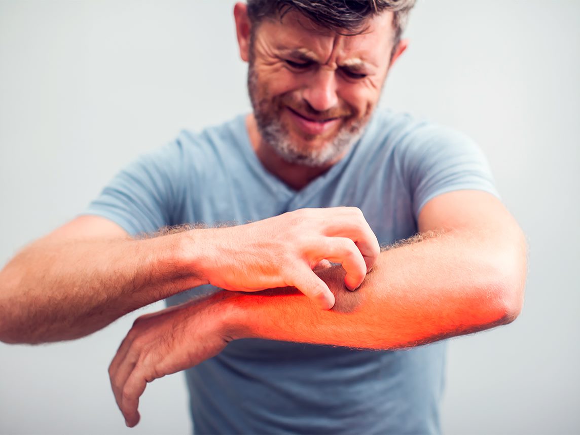 How to Manage Itchy Skin Caused by MPNs