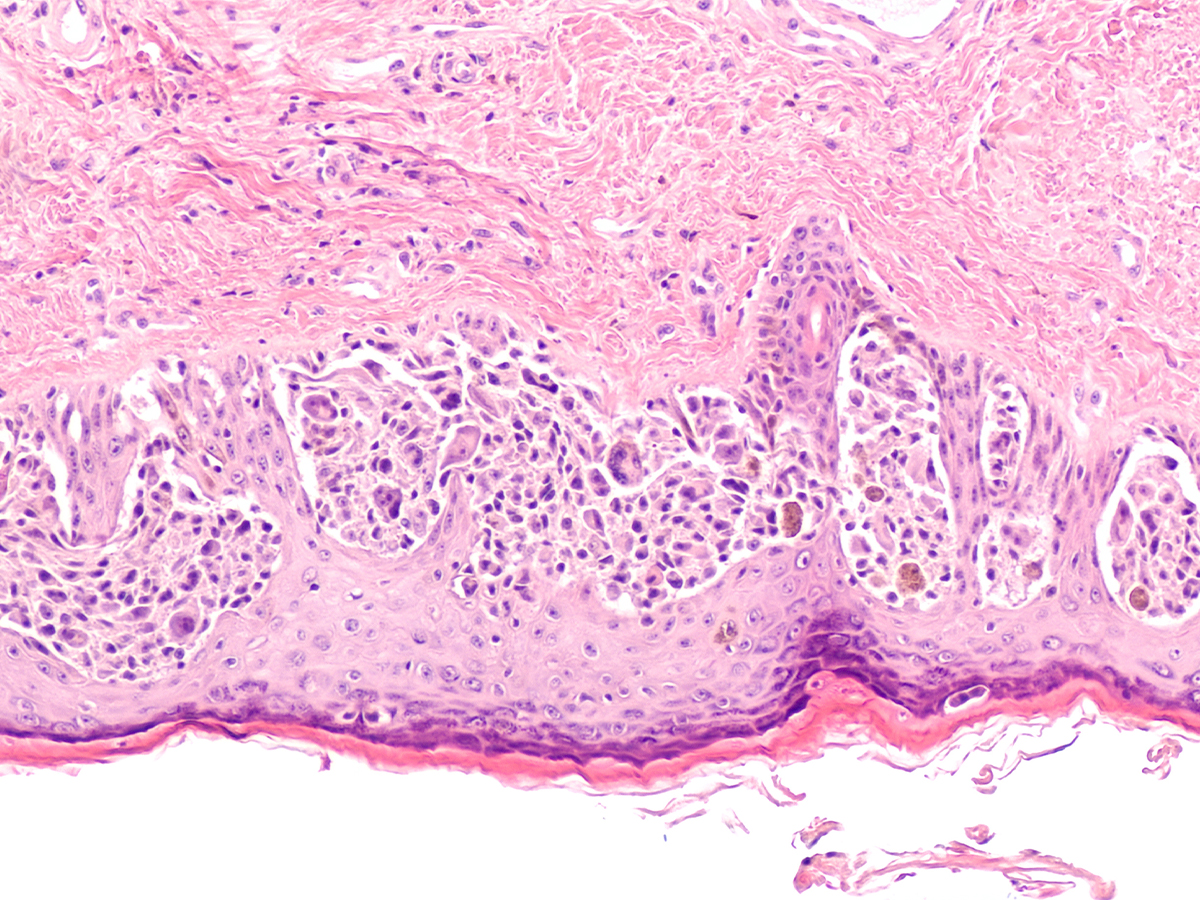 Are Myeloproliferative Neoplasms MPNs Cancer?