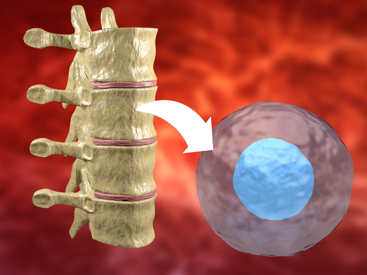 MPN Patient Shares Stem Cell Transplant Process