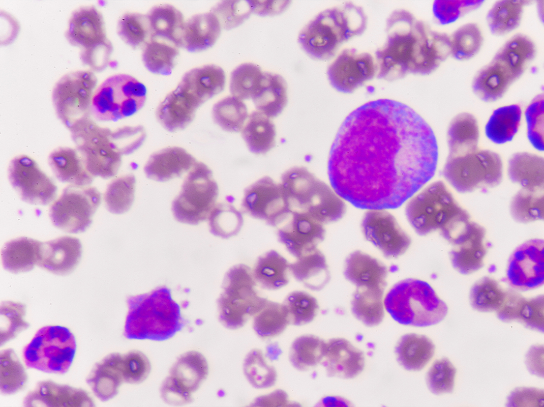 AML 101: Diagnosis and Induction Therapy