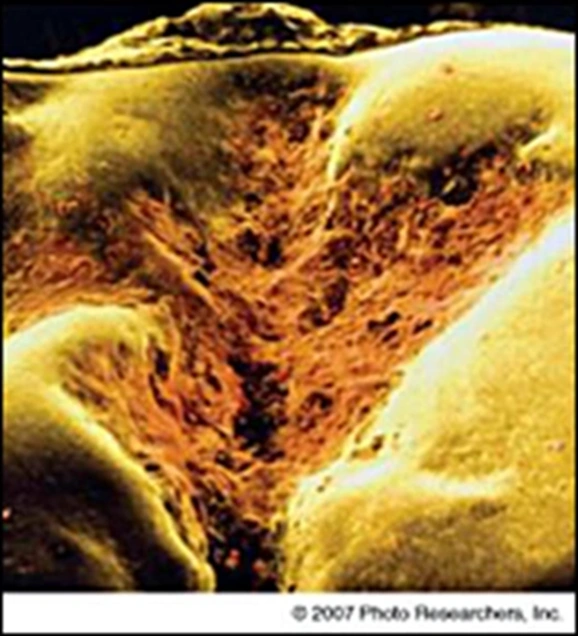 Carious Lesions - Professional Dental Terminology for the Dental ...