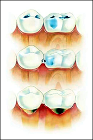 Carious Lesions - Professional Dental Terminology for the Dental ...