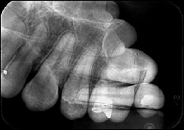 Exposure and Miscellaneous Errors - Intraoral Imaging: Basic Principles ...