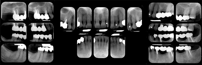 The Full Mouth X-ray Survey Identification Film Mounting, 51% OFF
