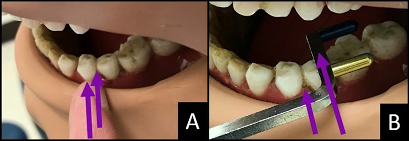 Horizontal Angulation: What is it? How do I find it? | Intraoral ...