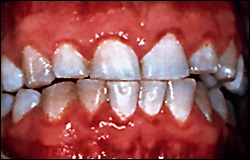 Introduction | The Oral Microbiome: A New View of Plaque Biofilm ...