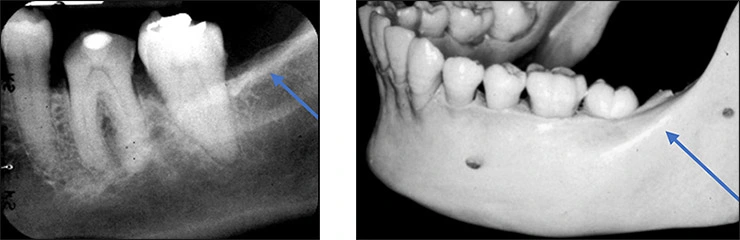 Mandibular Posterior Landmarks - Intraoral Radiographic Anatomy ...
