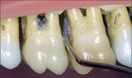 Diamond Coated File Scalers - Advanced Instrumentation for the General ...