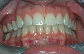 Attached Gingiva - The Intraoral and Extraoral Exam - Dentalcare