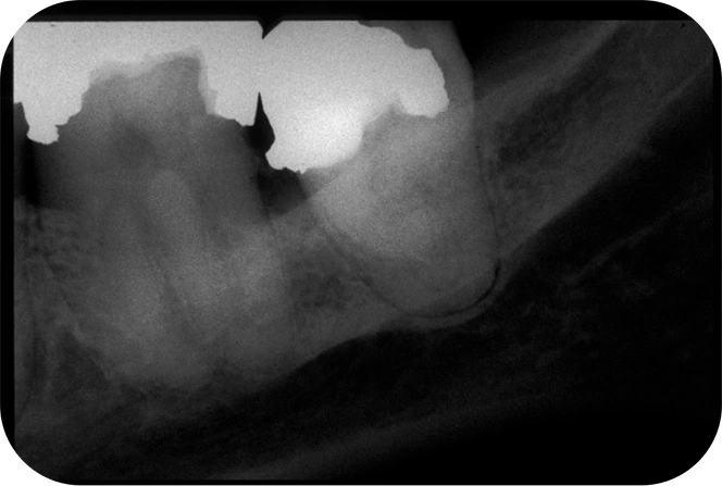 Exposure and Miscellaneous Errors - Intraoral Imaging: Basic Principles ...