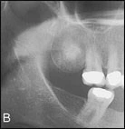 Diagnostic Information | A Mass of the Maxillary Tuberosity ...